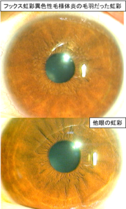フックス虹彩異色性毛様体炎 – 目医者情報
