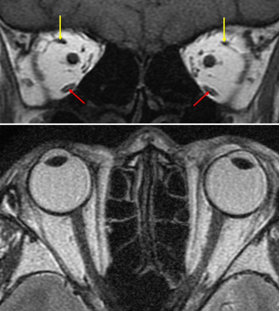 先天性外眼筋線維症CFEOM – 目医者情報