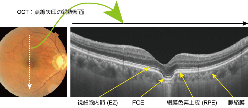 FCE: Focal choroidal excavation – 目医者情報