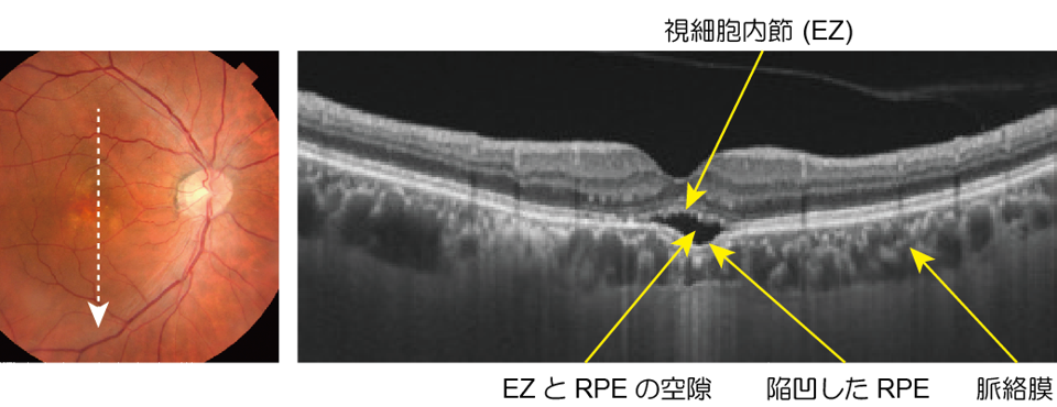 FCE: Focal choroidal excavation – 目医者情報