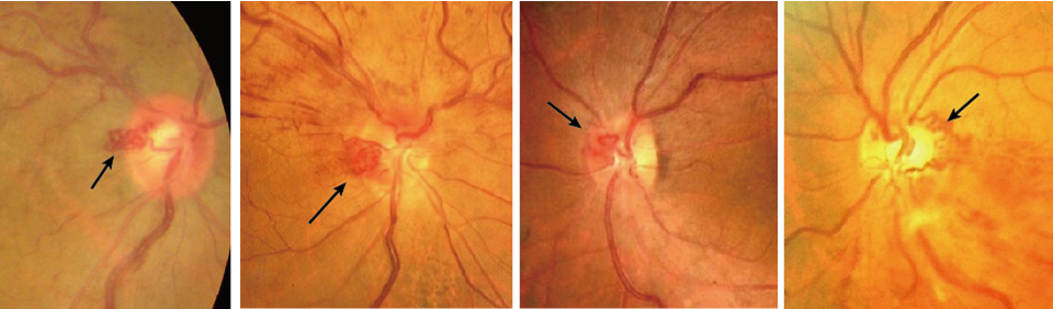 乳頭毛様短絡血管 Optociliary shunt vessel – 目医者情報