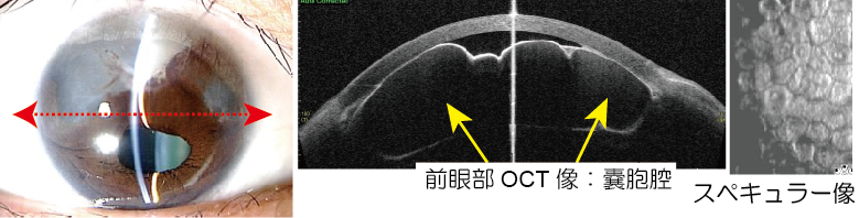 虹彩色素上皮嚢胞と虹彩実質嚢胞 – 目医者情報