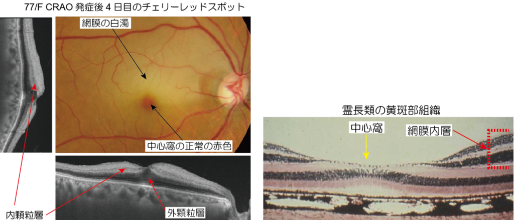 網膜中心動脈閉塞症 CRAO – 目医者情報