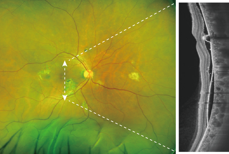 MPPEでみられるドーナッツ状網膜下滲出斑 – 目医者情報