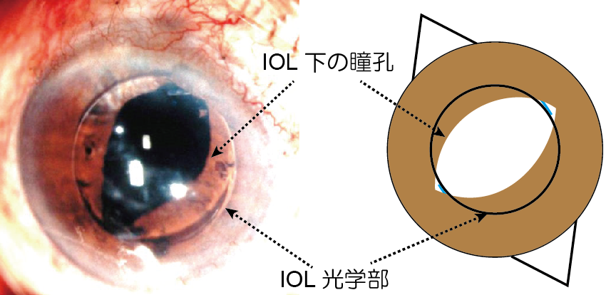 虹彩捕獲 iris capture – 目医者情報