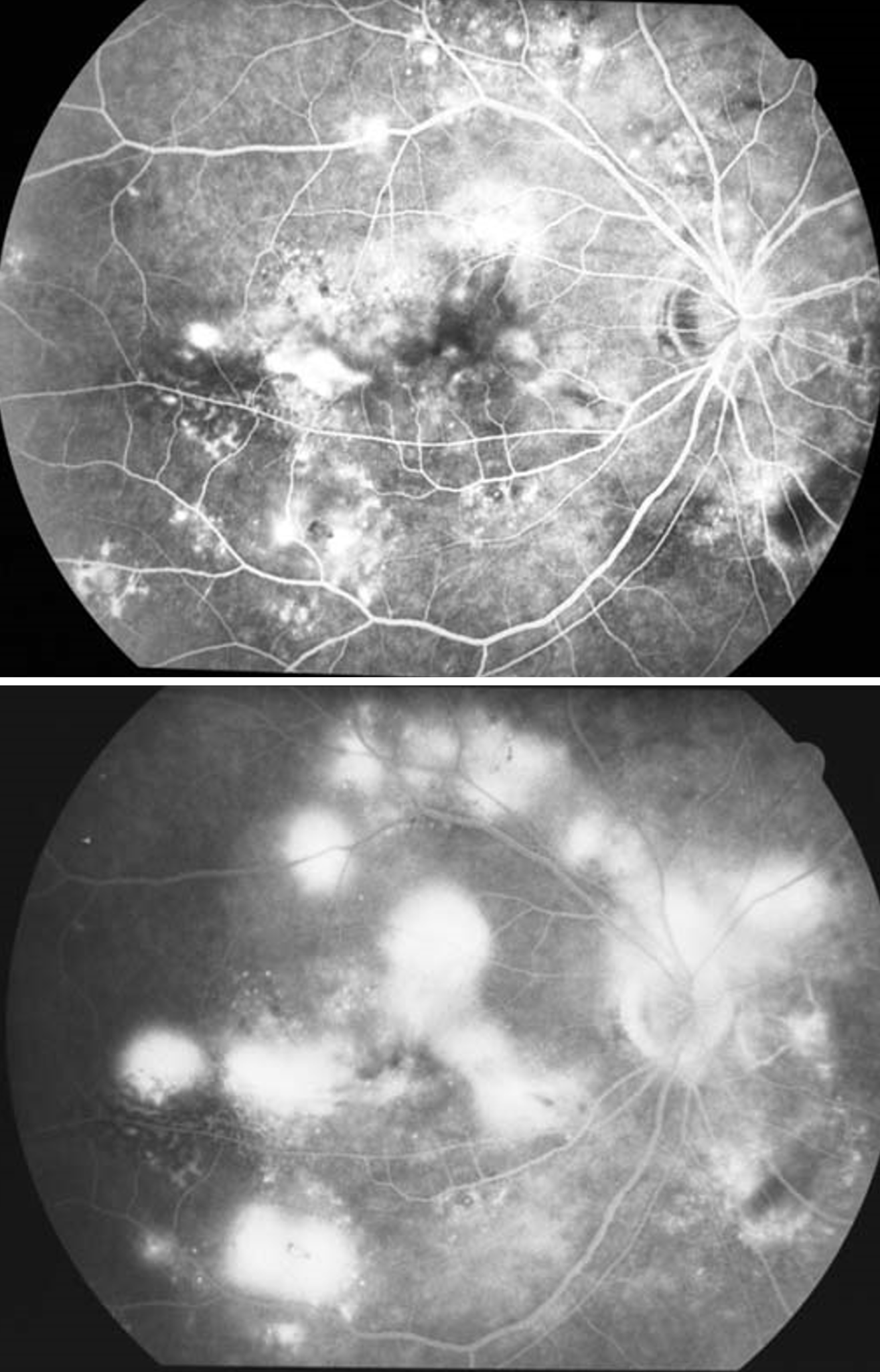 MPPEでみられるドーナッツ状網膜下滲出斑 – 目医者情報