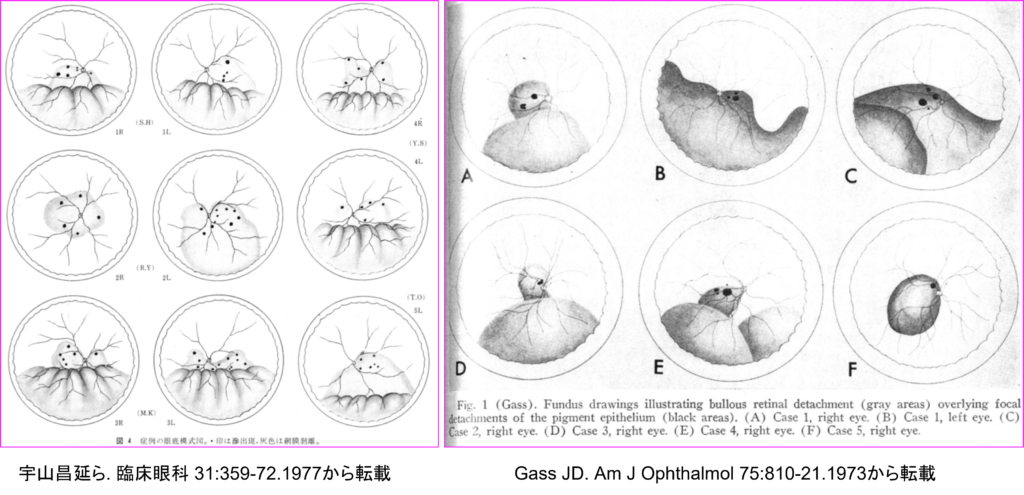 MPPE と Bullous retinal detachment – 目医者情報