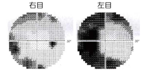 視神経、頭蓋内疾患と誤診されるAZOOR – 目医者情報