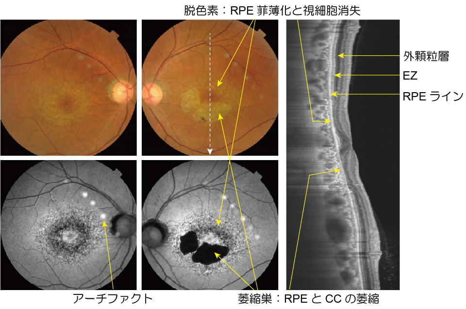 中心性輪紋状脈絡膜ジストロフィ：CACD – 目医者情報