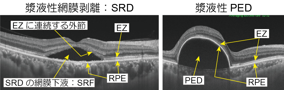 漿液性網膜剥離 SRDと漿液性 PED – 目医者情報