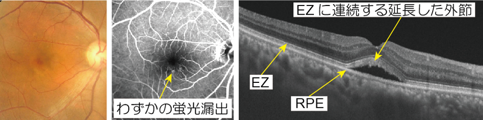 漿液性網膜剥離 SRDと漿液性 PED – 目医者情報
