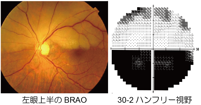 一過性黒内障（発作）とBRAO – 目医者情報