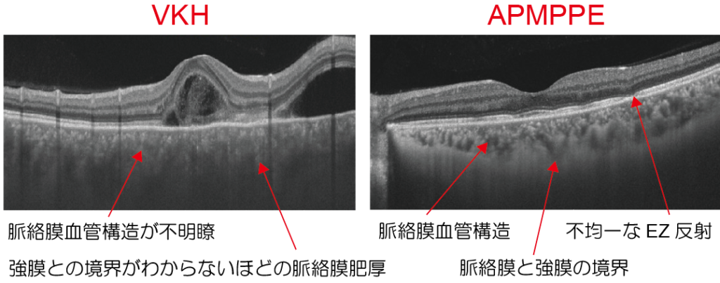 APMPPE と VKH の鑑別 – 目医者情報