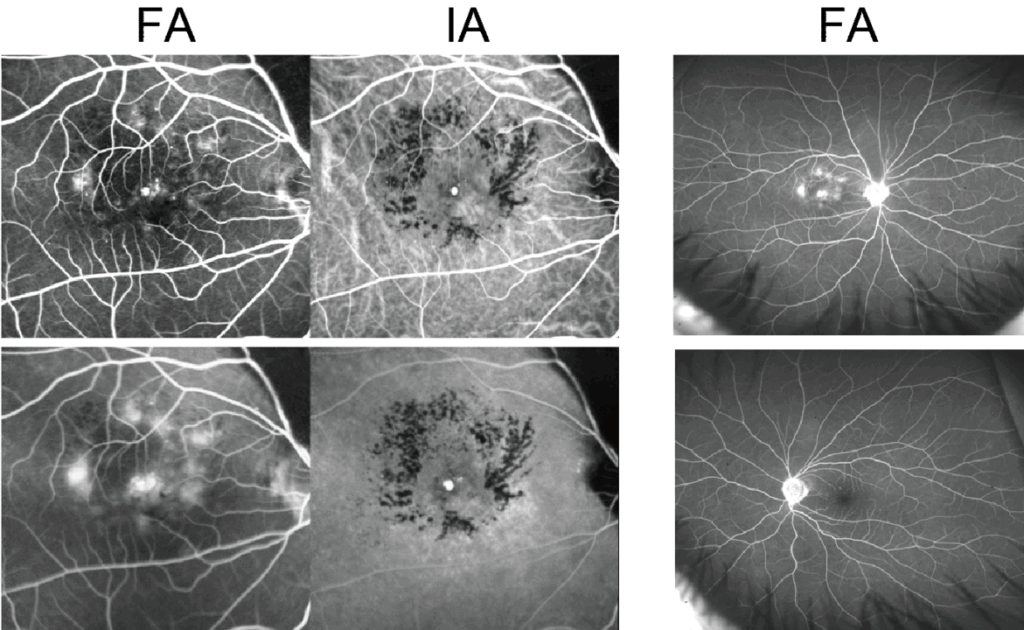 MacTel type 1 – 目医者情報