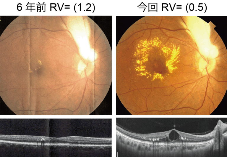 MacTel type 1 – 目医者情報