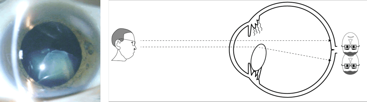 核白内障と三重視 – 目医者情報